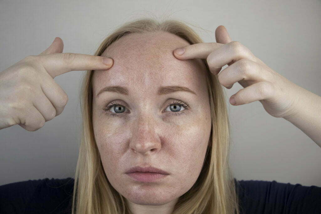 Le Guide Ultime Pour Lutter Contre La Peau Grasse Esprit And Santé